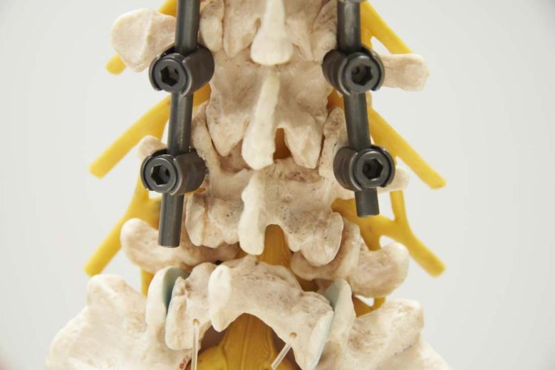 Lumbar Fusion | Precision Spine & Orthopedics Inc