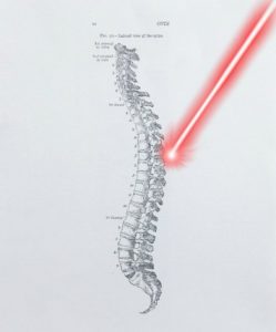 Laser Spine Surgery | Precision Spine & Orthopedics Inc