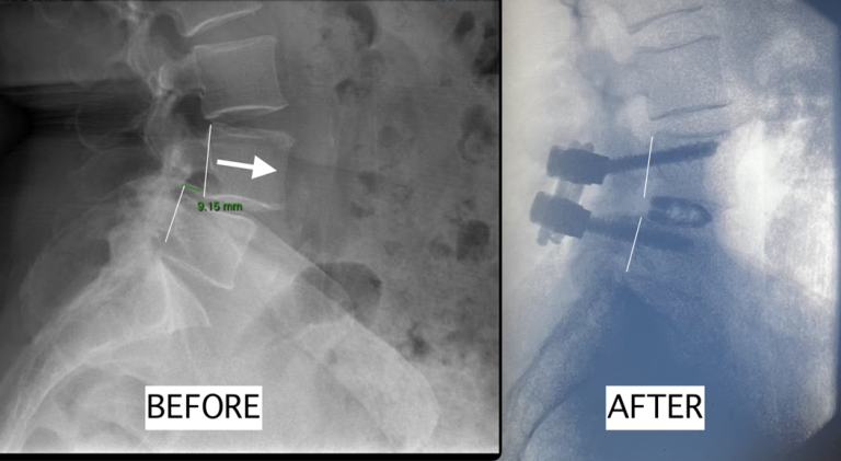 Lumbar Spine – Minimally Invasive TLIF | Precision Spine & Orthopedics Inc