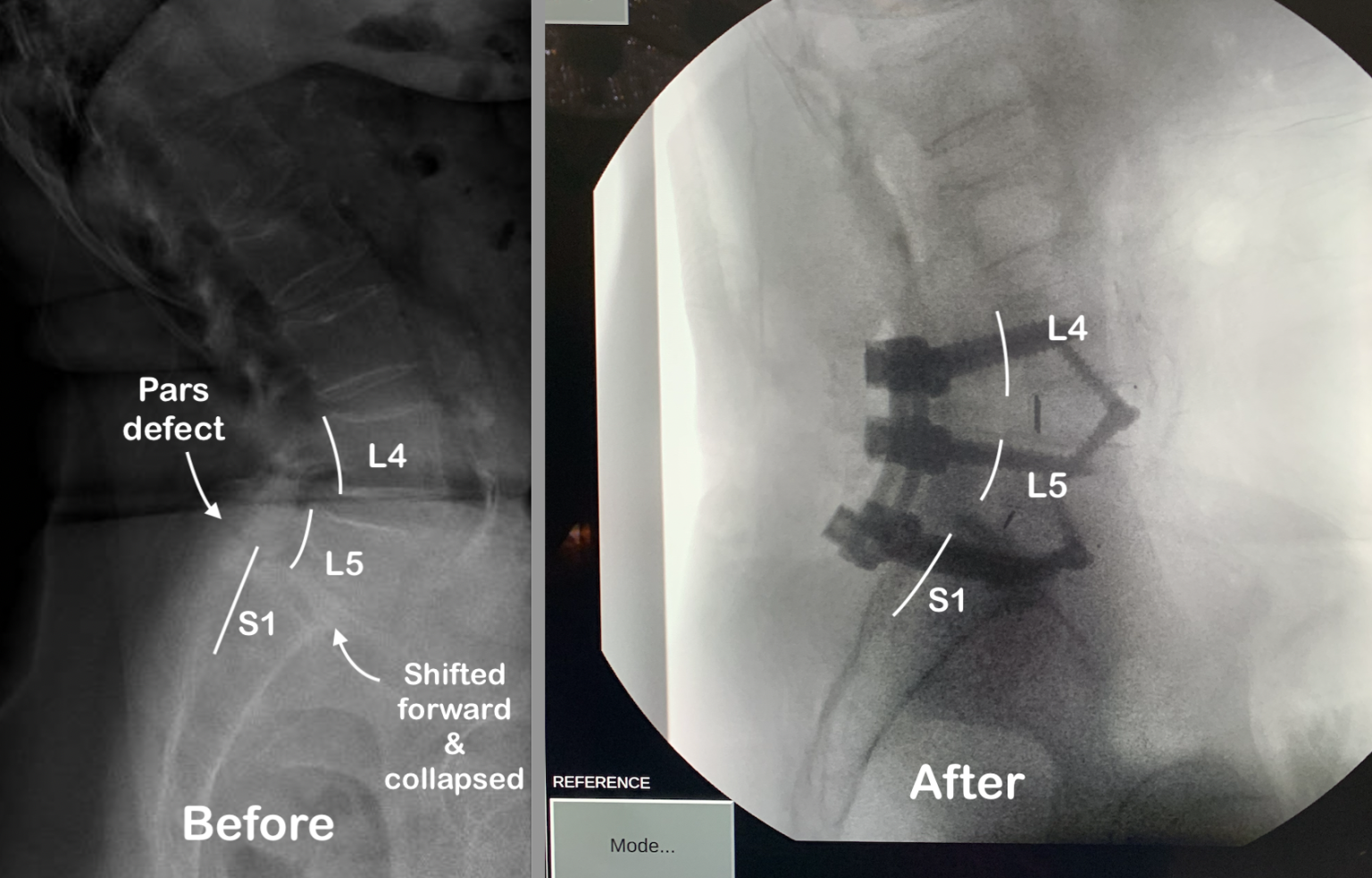 Procedures | Precision Spine & Orthopedics Inc